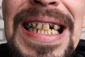 Why Some Drugs Make You Grind Your Teeth | Struggling With Addiction